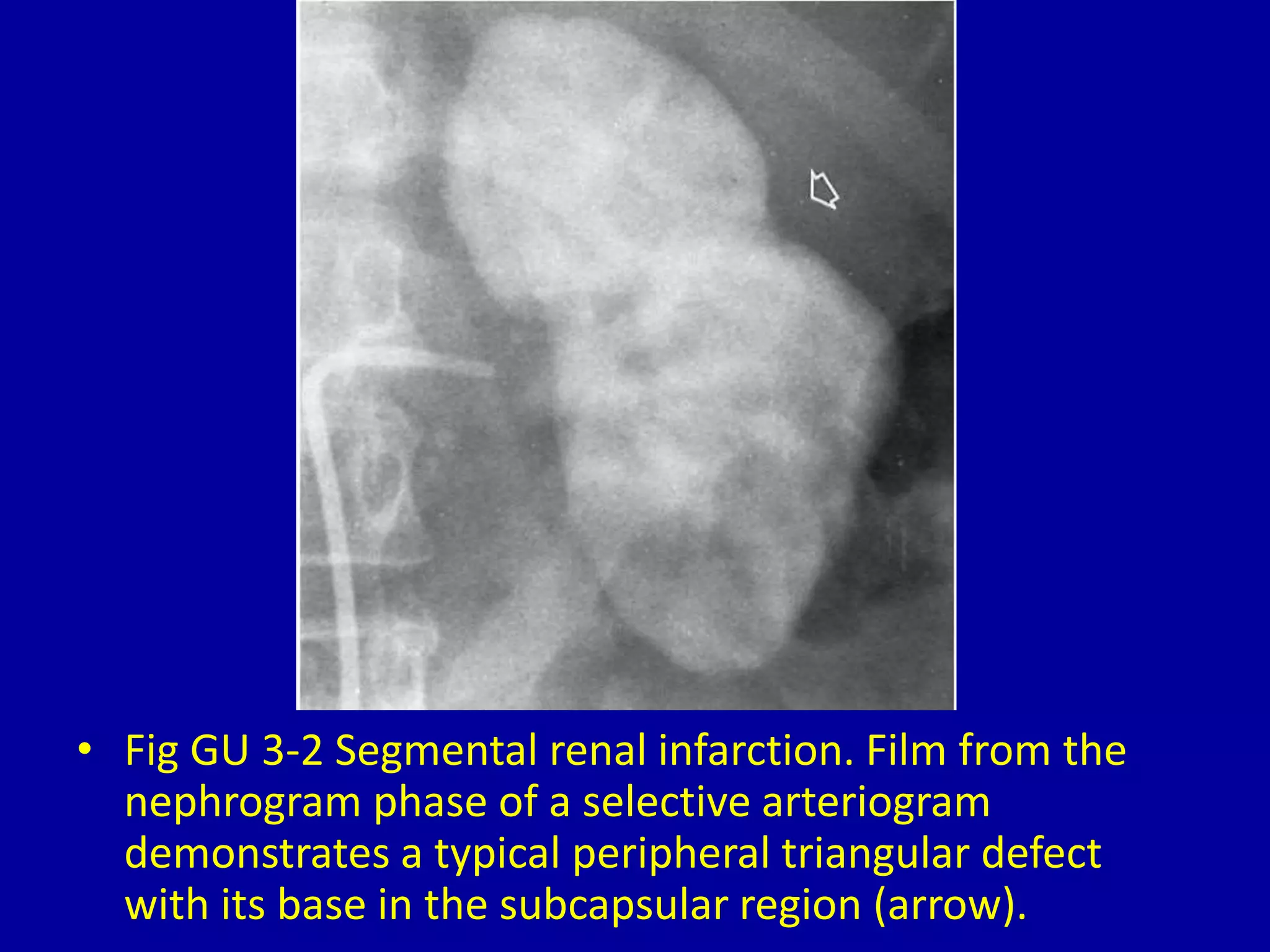 3 unilateral small, scarred kidney | PPTX