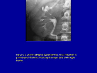 3 unilateral small, scarred kidney | PPTX
