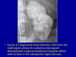 3 unilateral small, scarred kidney | PPTX