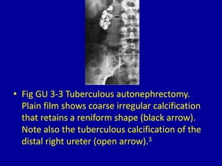 3 unilateral small, scarred kidney | PPTX