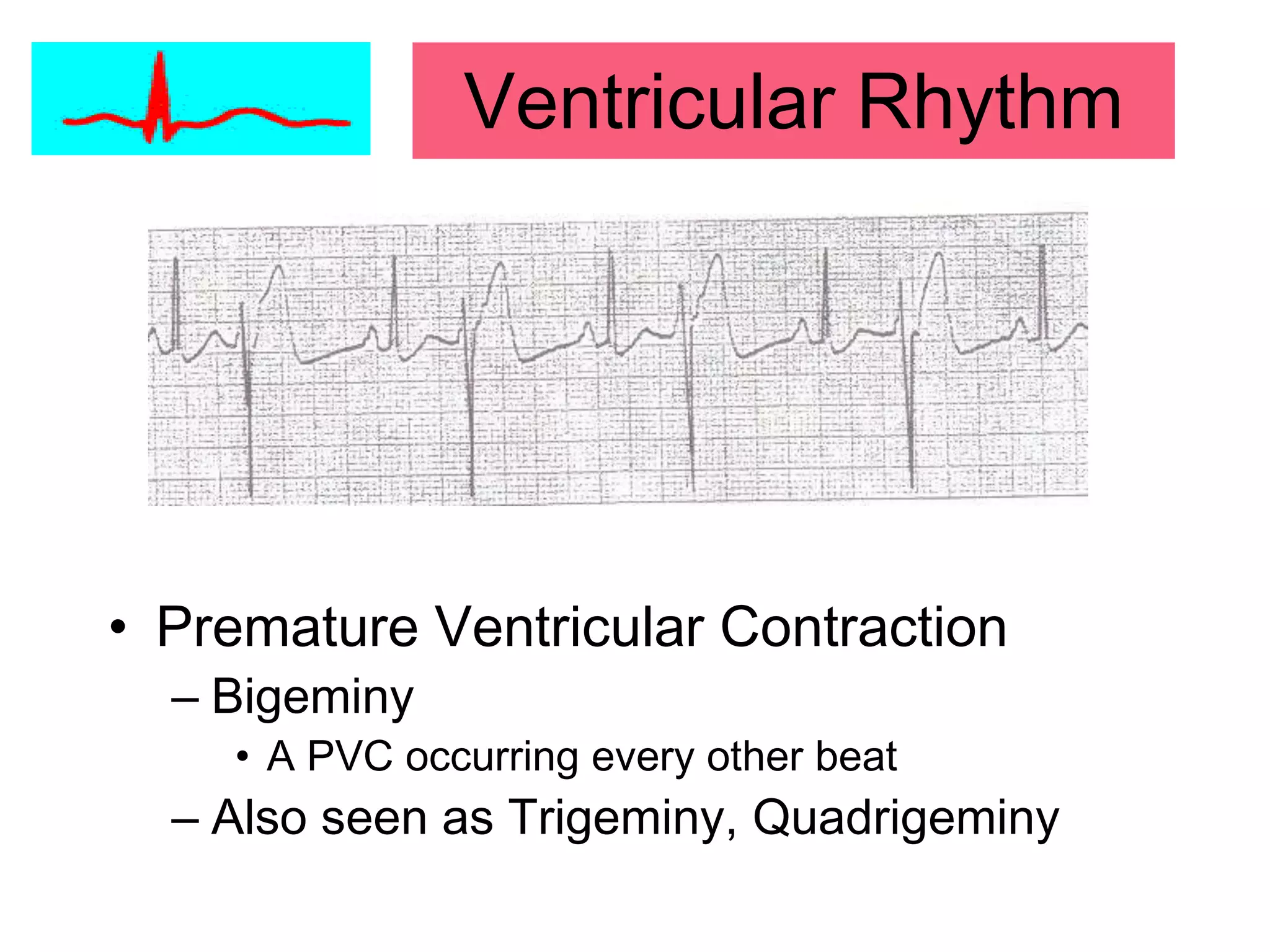 Perioperative%20%20%20%20%20%20%20%20 arrhythmias | PPTX