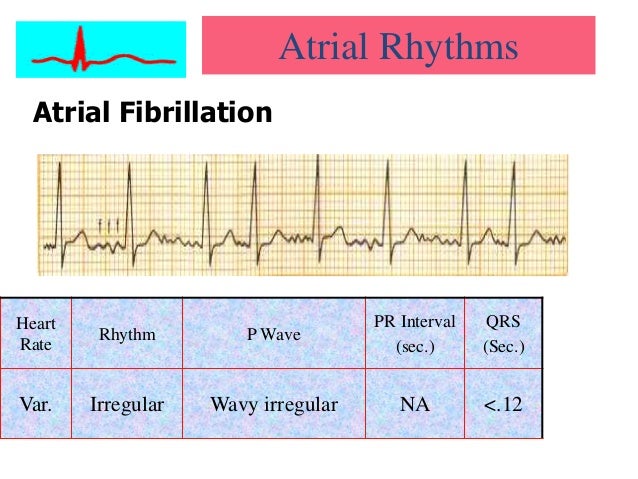 Perioperative%20%20%20%20%20%20%20%20 arrhythmias