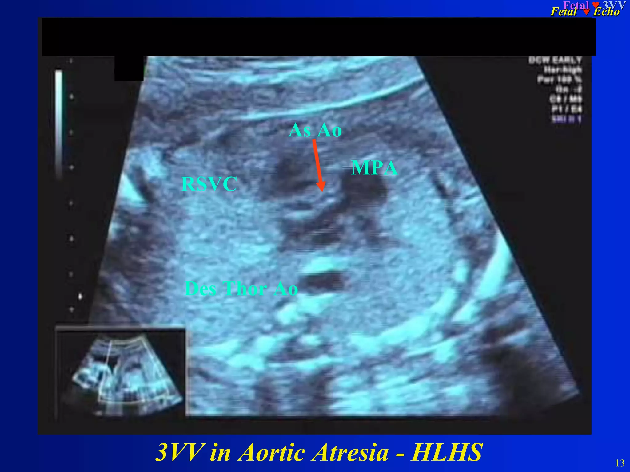 3 vessel views | PPTX