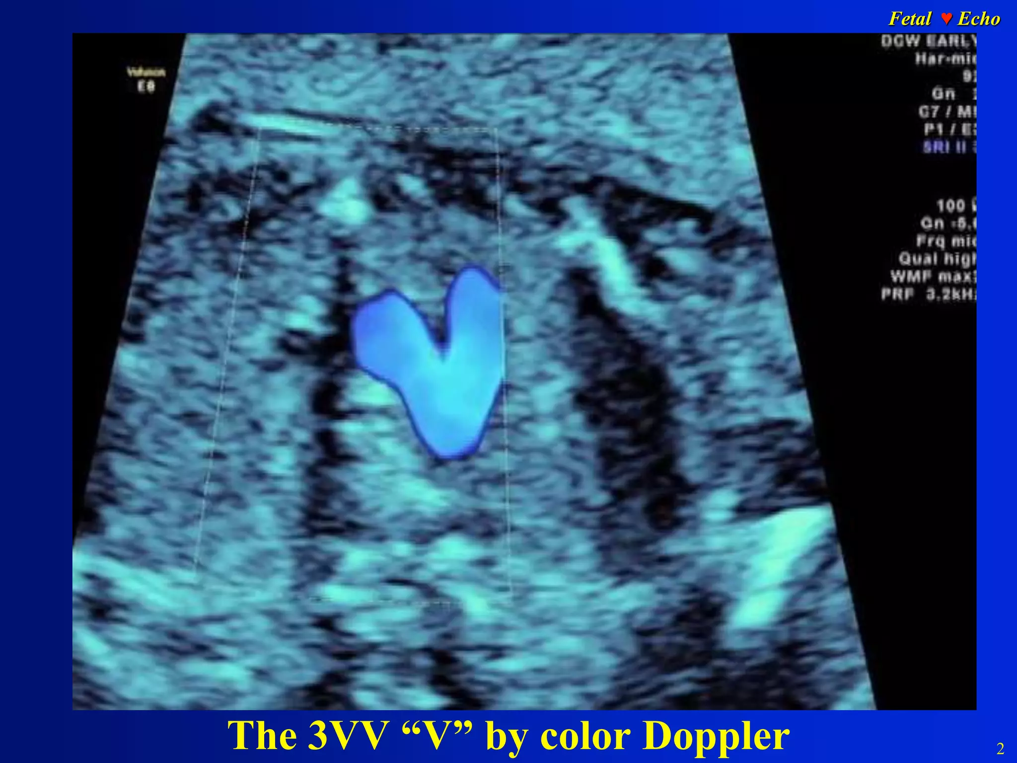 3 vessel views | PPTX