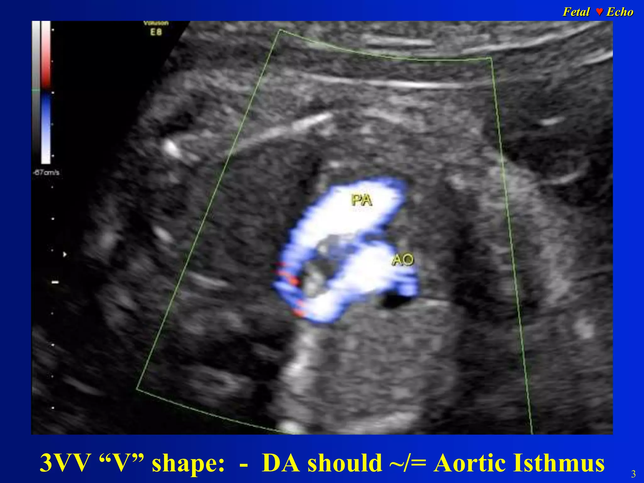 3 vessel views | PPTX