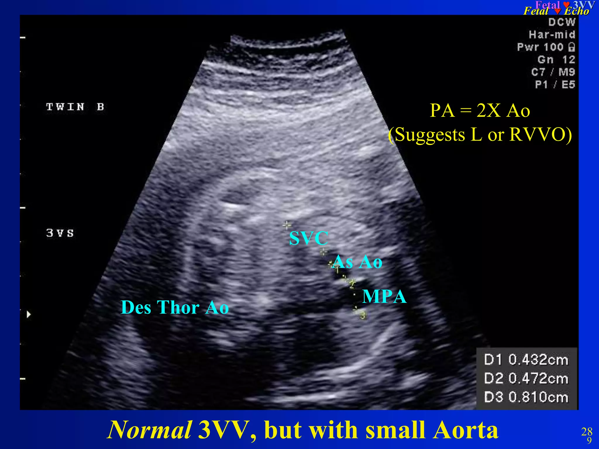 3 vessel views | PPTX