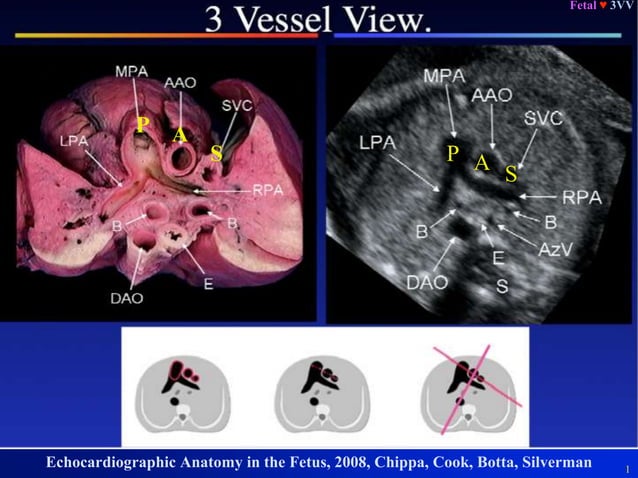 3 vessel views | PPTX | Heart and Cardiovascular Diseases | Diseases ...