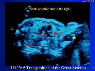 3 vessel views | PPTX