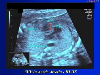 3 vessel views | PPTX