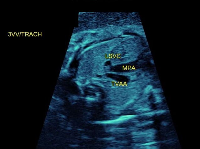 3 vessel views | PPTX | Heart and Cardiovascular Diseases | Diseases ...