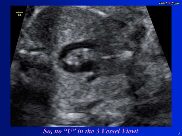 3 vessel views | PPTX | Heart and Cardiovascular Diseases | Diseases ...