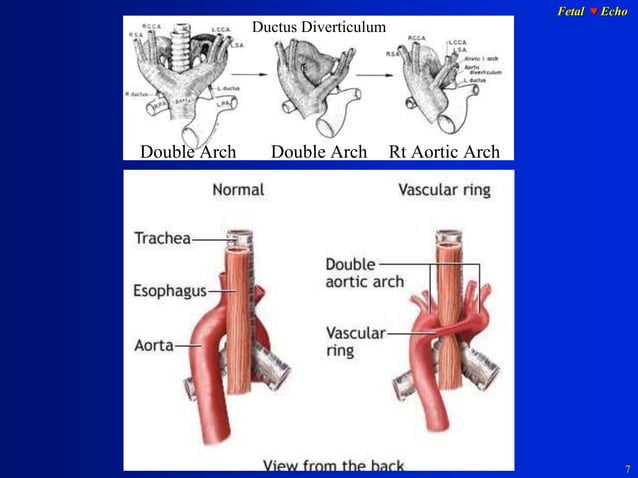 3 vessel views | PPTX | Heart and Cardiovascular Diseases | Diseases ...