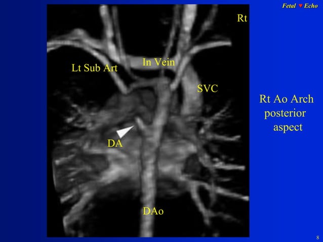 3 vessel views | PPTX | Heart and Cardiovascular Diseases | Diseases ...