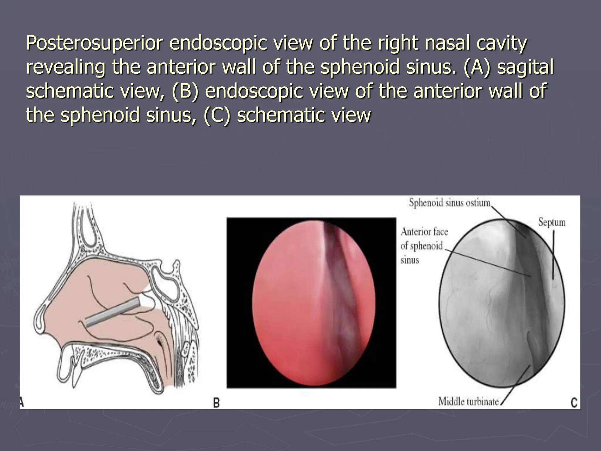 endoscopic_ana_of_nose__PNS in otolaryngology .ppt