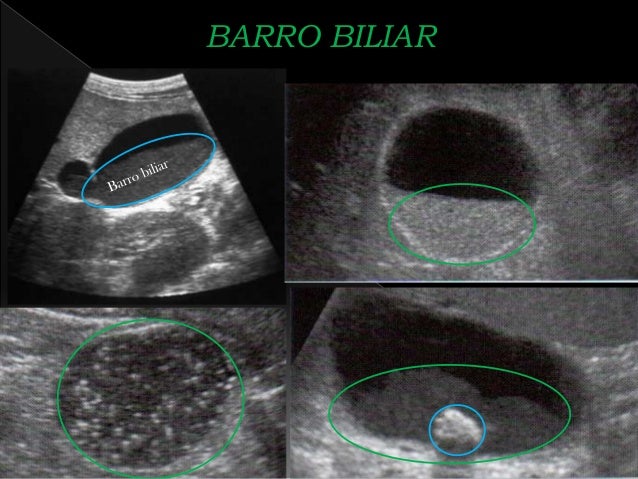 Clase de vesicula y vias biliares - Ecografia