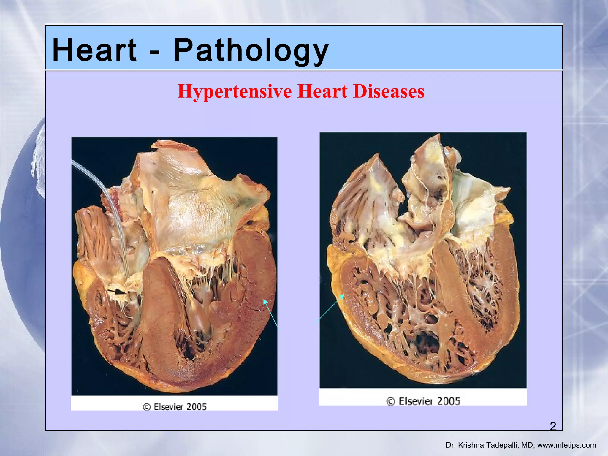 4. heart pathology; hypertensive heart diseases | PPT