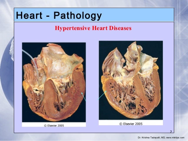 4. heart pathology; hypertensive heart diseases