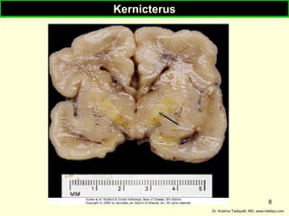 Kernicterus Gross
