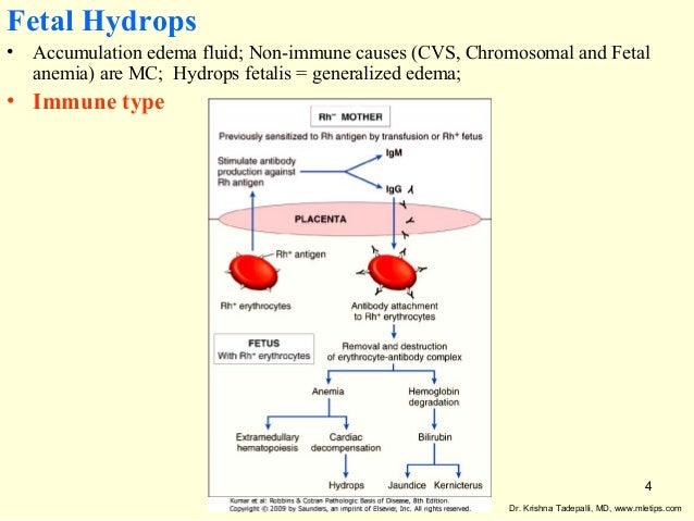4. hydrops fetalis; pedatric pathology