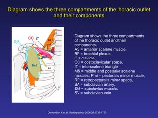 Thoracic Outlet Syndrome | PPT