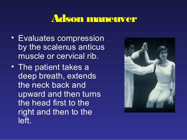 Thoracic Outlet Syndrome