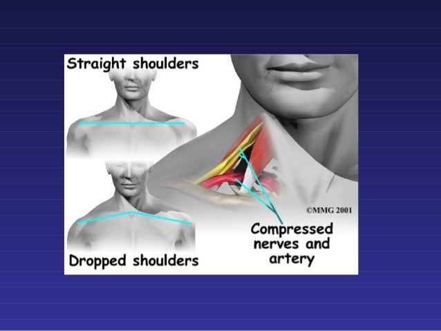 Thoracic Outlet Syndrome