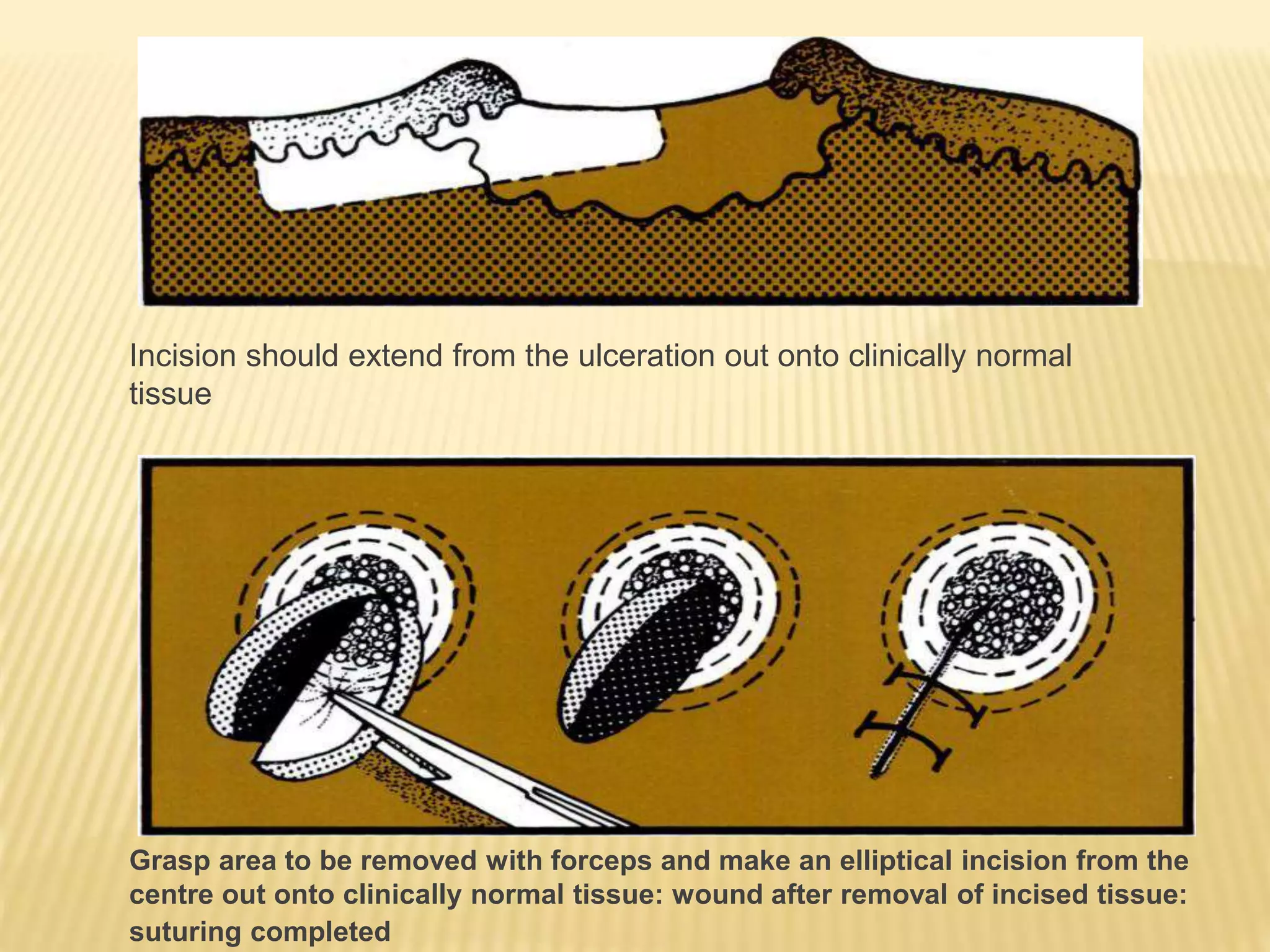 Biopsy ( oral pathology) | PPTX