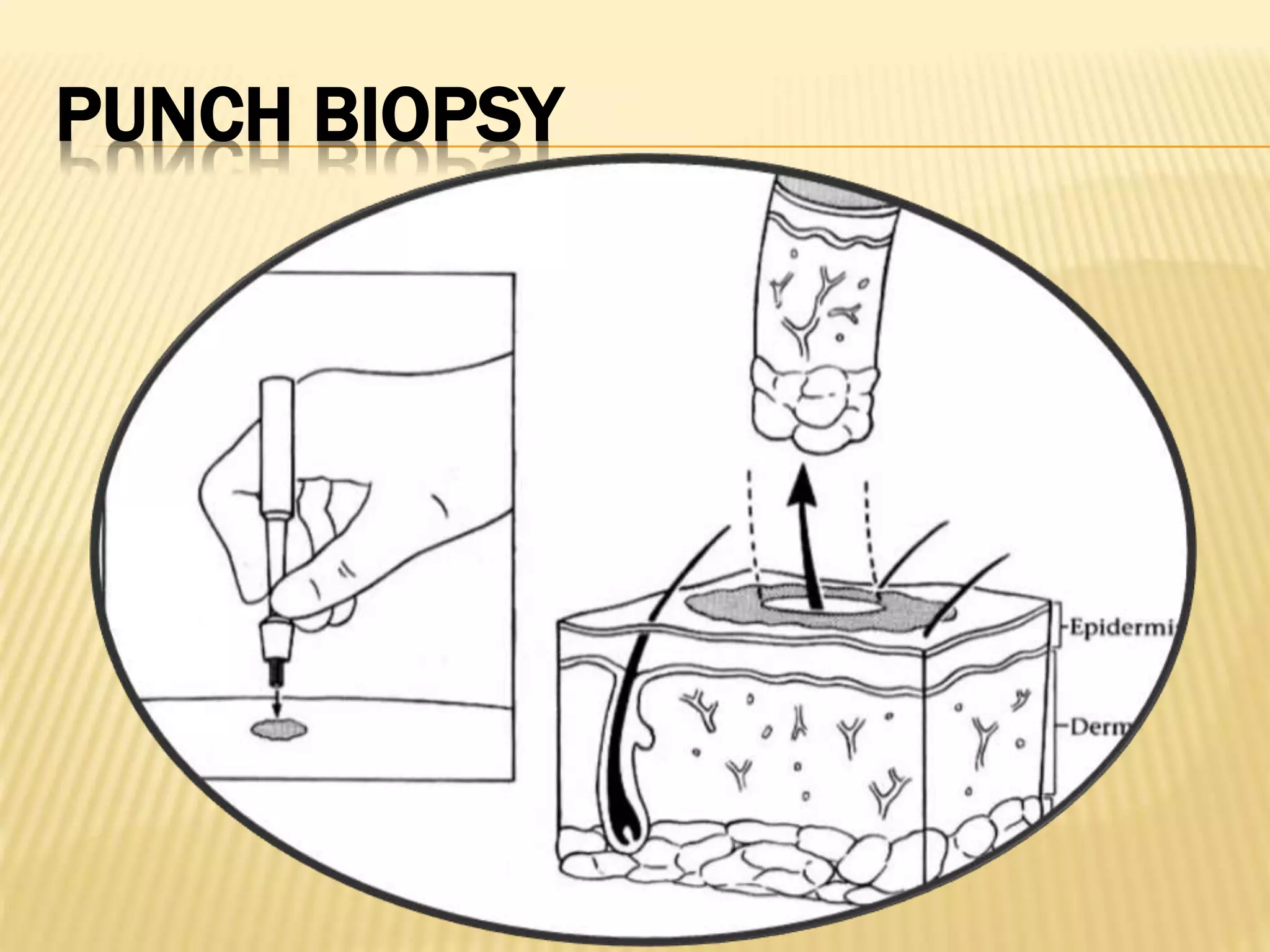 Biopsy ( oral pathology) | PPTX