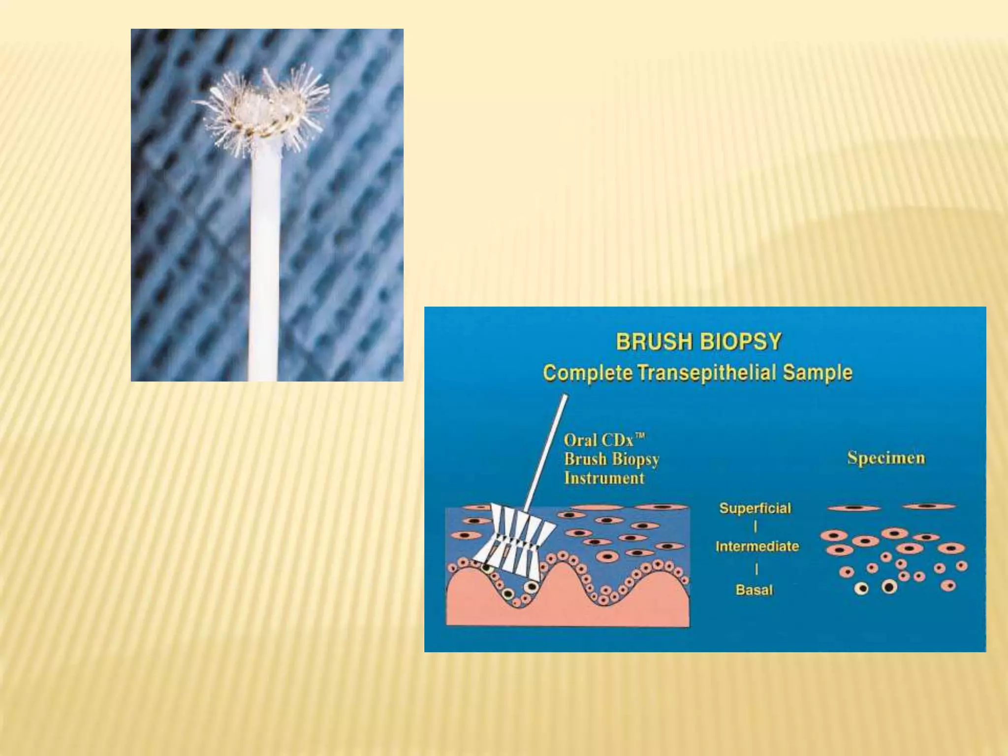 Biopsy ( oral pathology) | PPTX