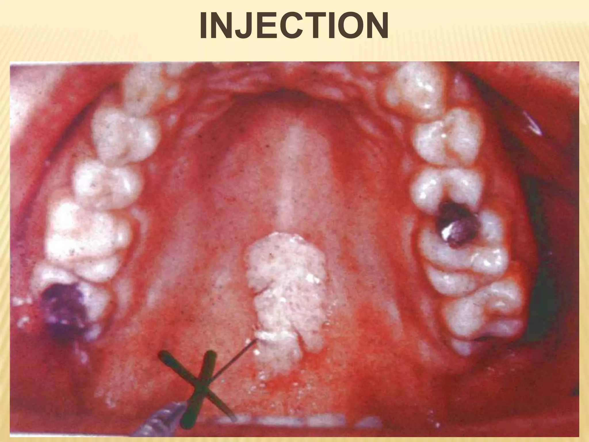 Biopsy ( oral pathology) | PPTX