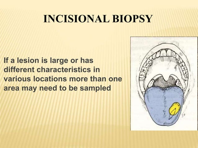Biopsy ( oral pathology) | PPTX