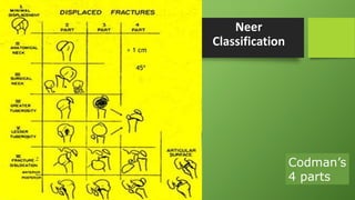 4. humerus fractures | PPTX | Death, Injury, or Military Conflict ...