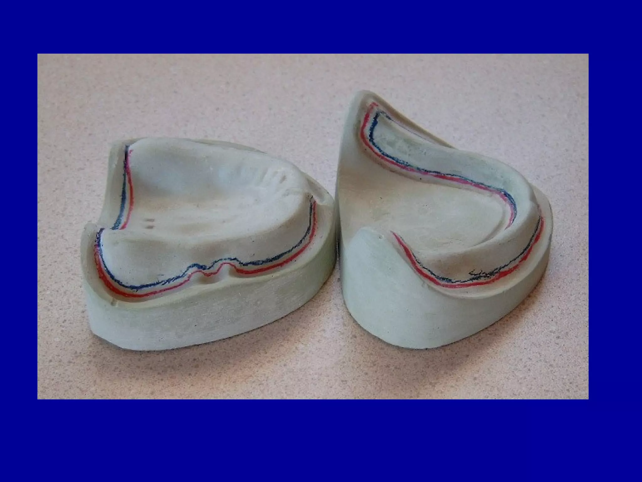 custom trays & master casts | PPT