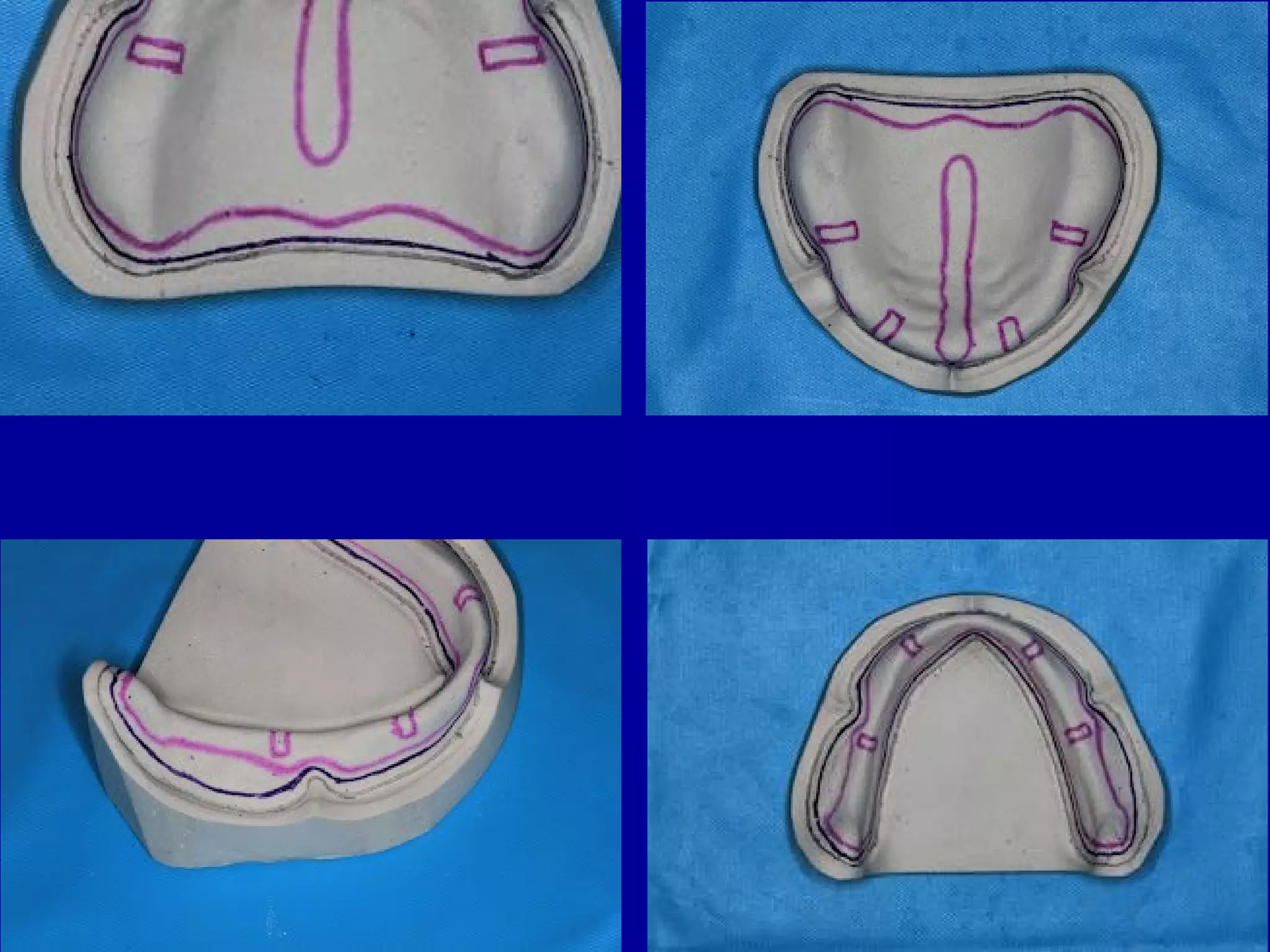 custom trays & master casts | PPT