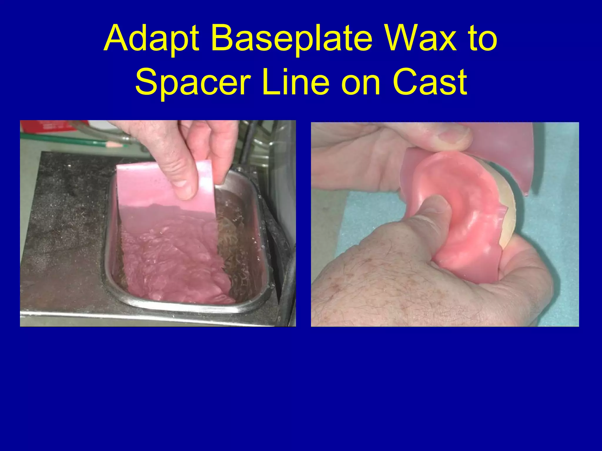 custom trays & master casts | PPT