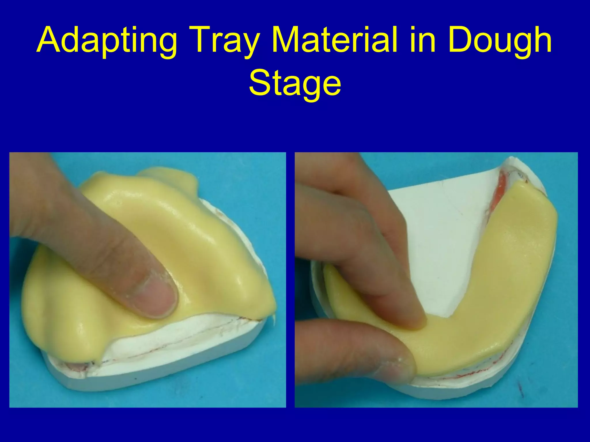 custom trays & master casts | PPT