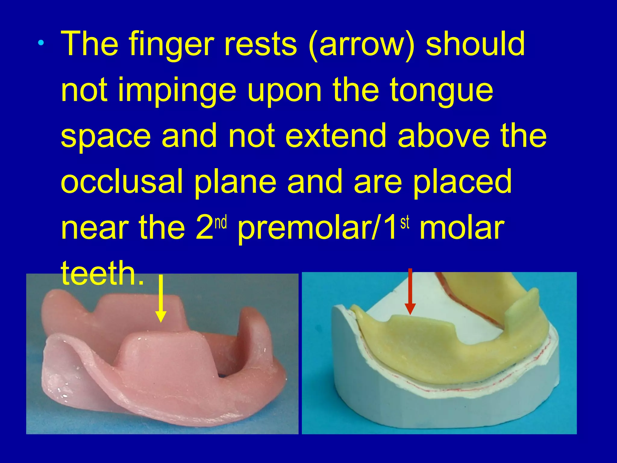 custom trays & master casts | PPT