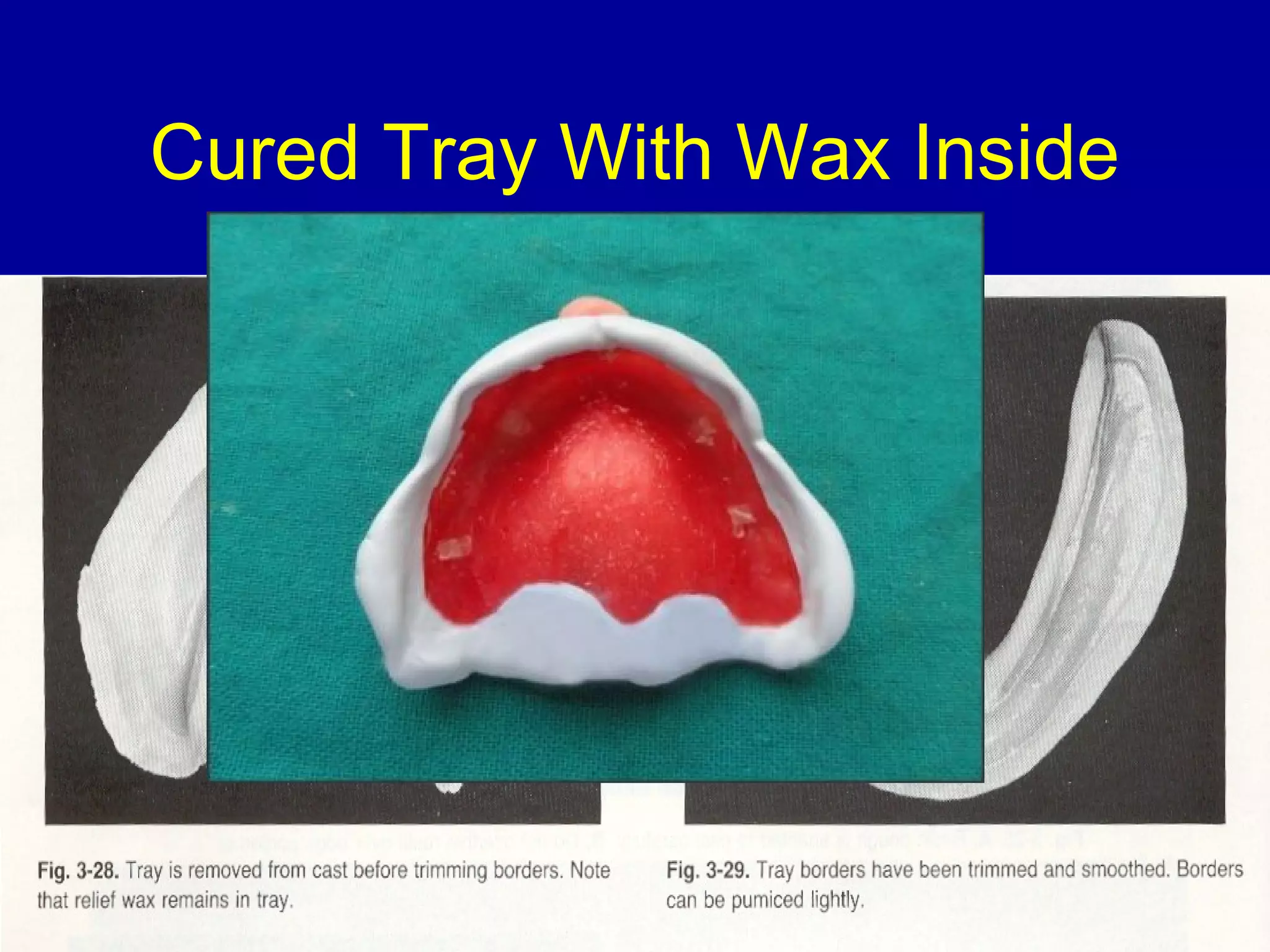 custom trays & master casts | PPT