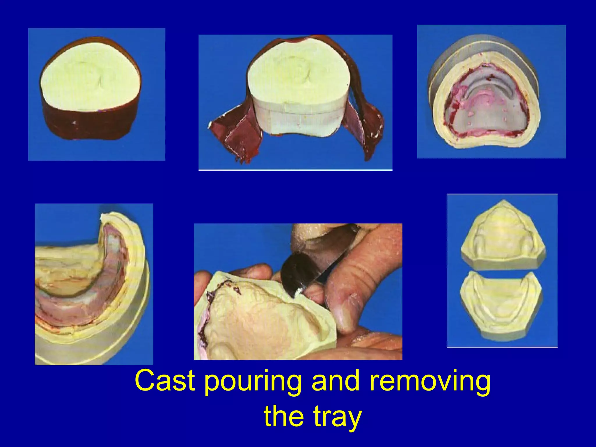 custom trays & master casts | PPT