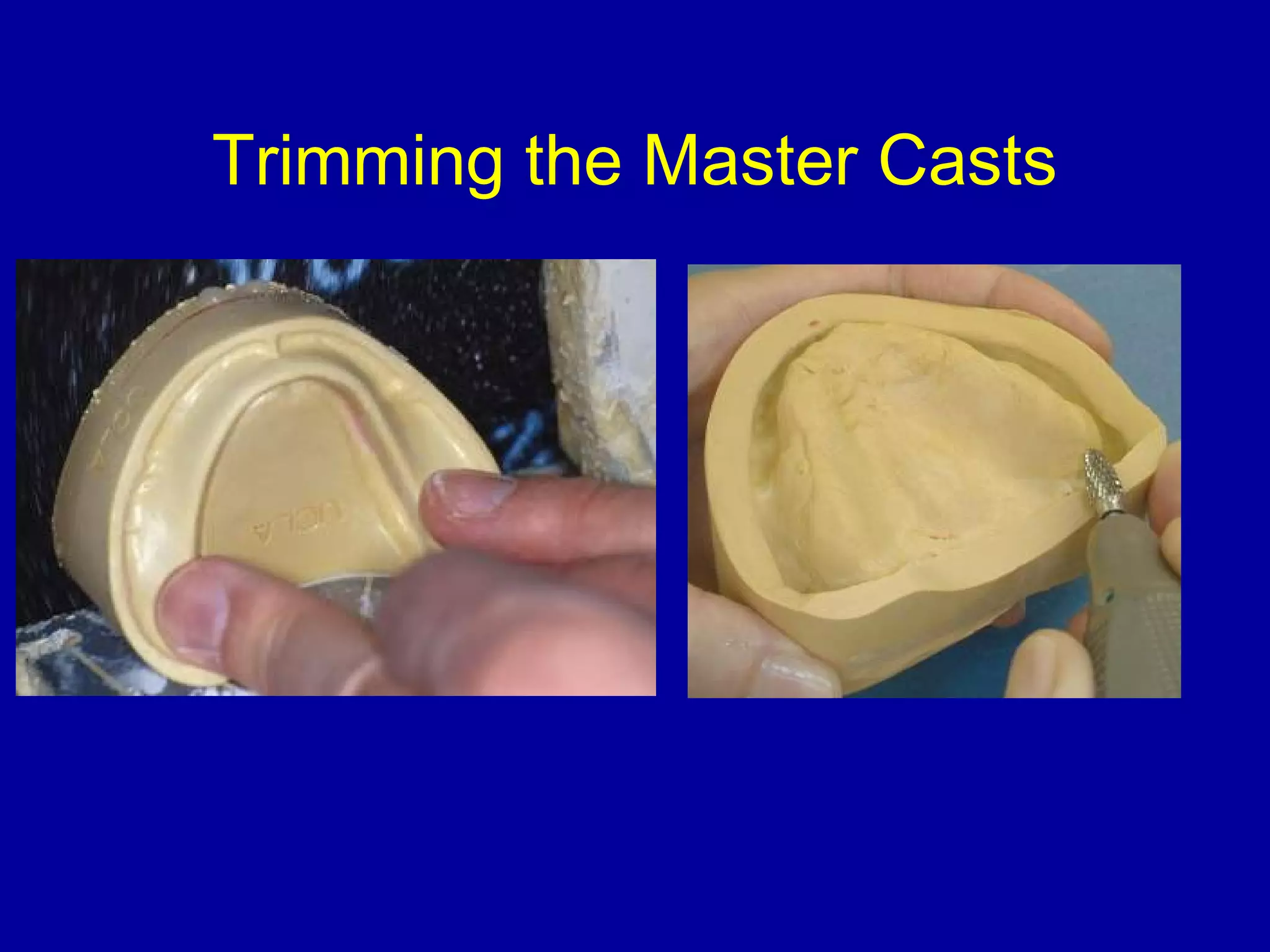 custom trays & master casts | PPT