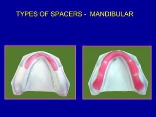 custom trays & master casts | PPT