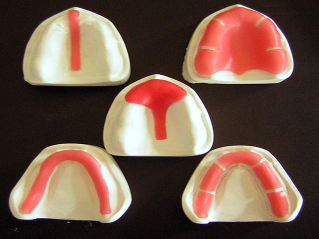 custom trays & master casts | PPT | Oral care | Personal Care