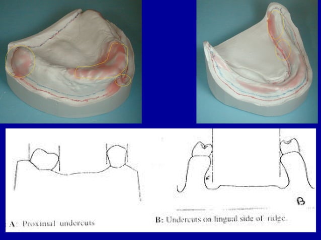 custom trays & master casts | PPT | Oral care | Personal Care