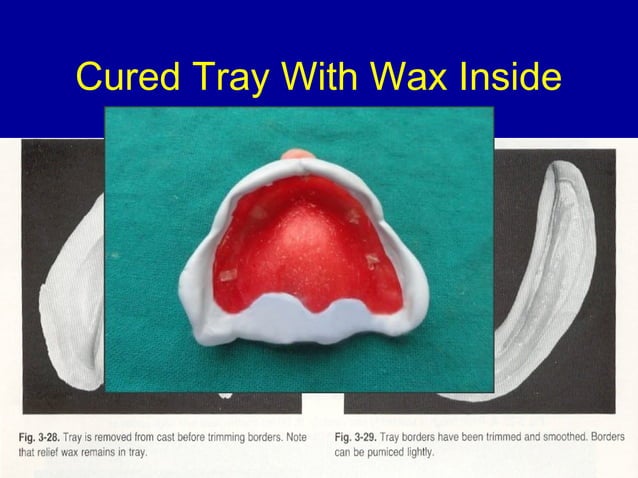 custom trays & master casts | PPT | Oral care | Personal Care