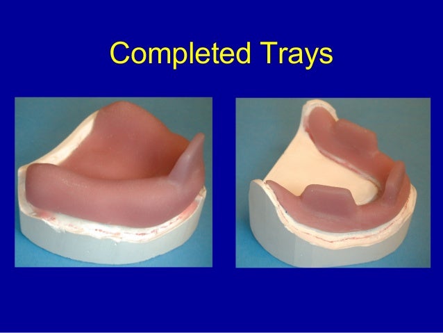 custom trays & master casts
