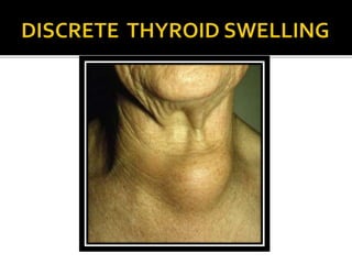 Clinically Discrete Swellings Of Thyroid Gland | PPTX | Thyroid ...