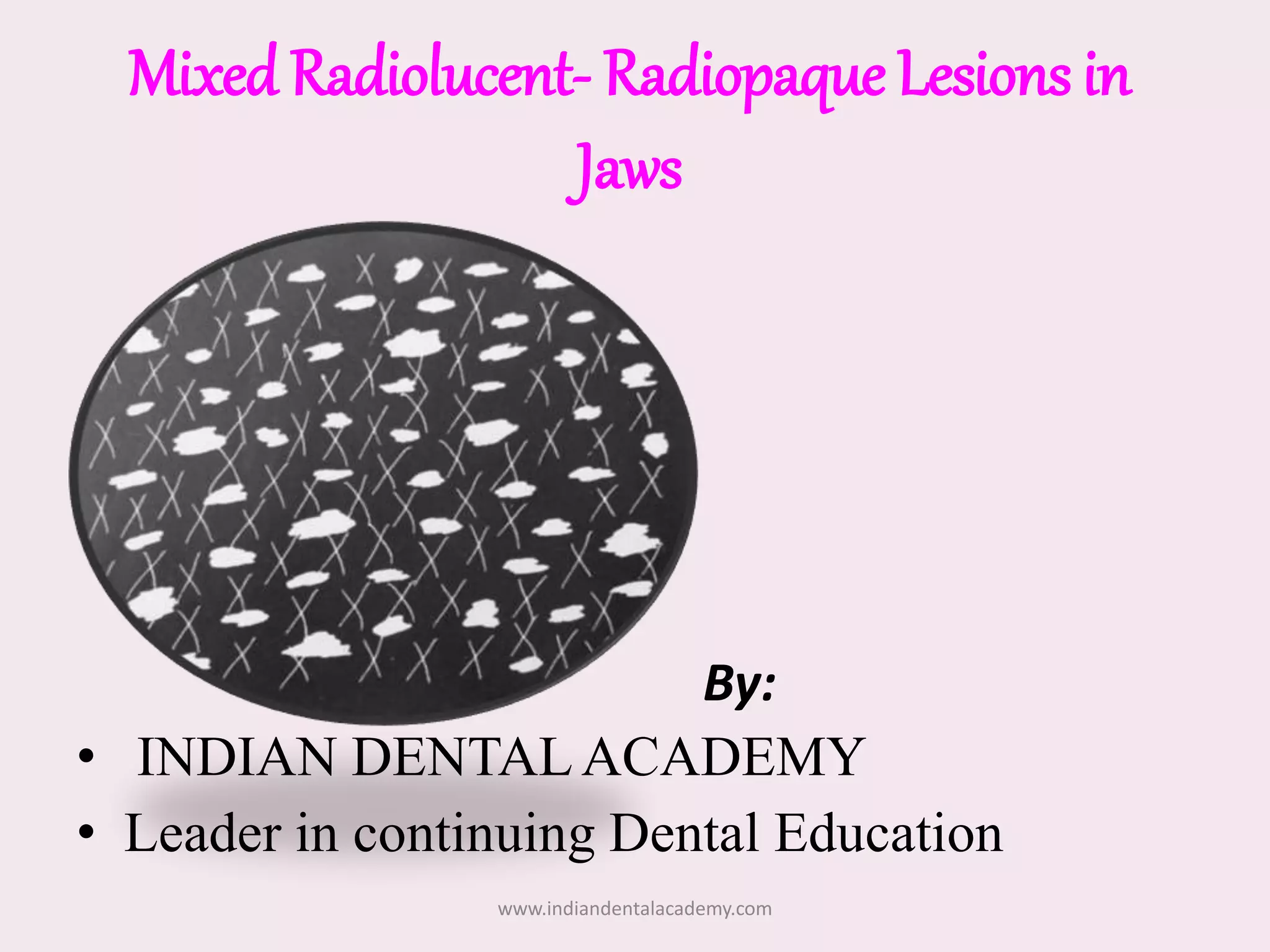 mixed radiolucent and radiopaque lesions / oral surgery courses | PPTX