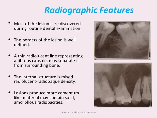 mixed radiolucent and radiopaque lesions / oral surgery courses