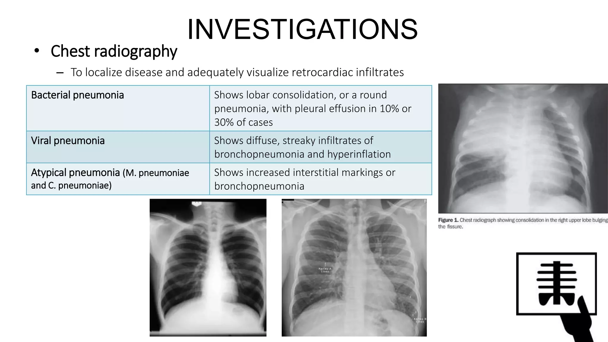 4. pneumonia paediatrics | PPTX