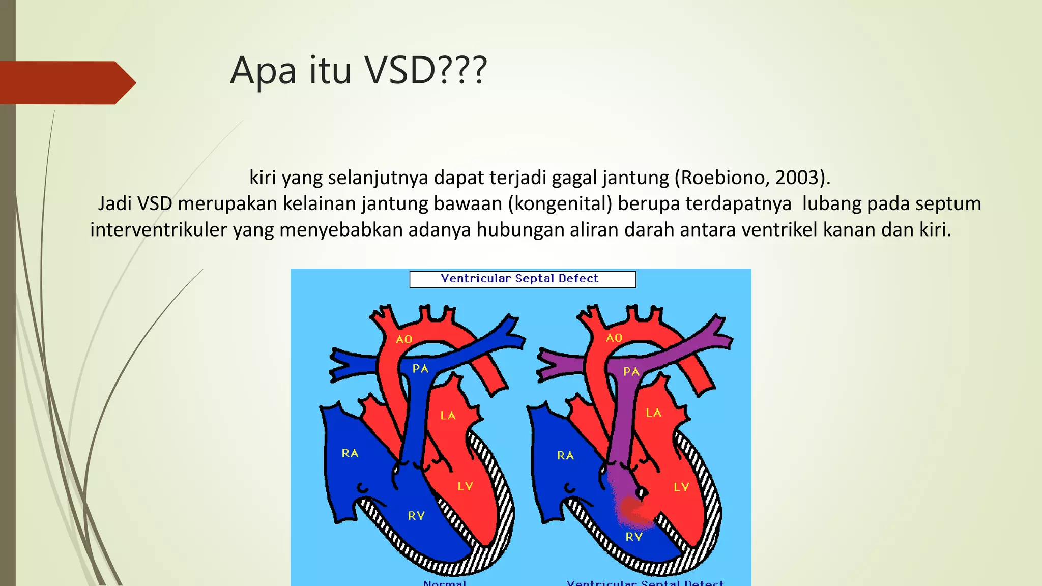 ASKEP VENTRICULAR SEPTAL DEFECT (VSD) | PPTX